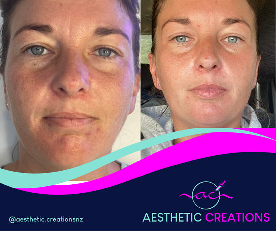 Cosmetic Injectables | Aesthetic Creations | North Canterbury ...